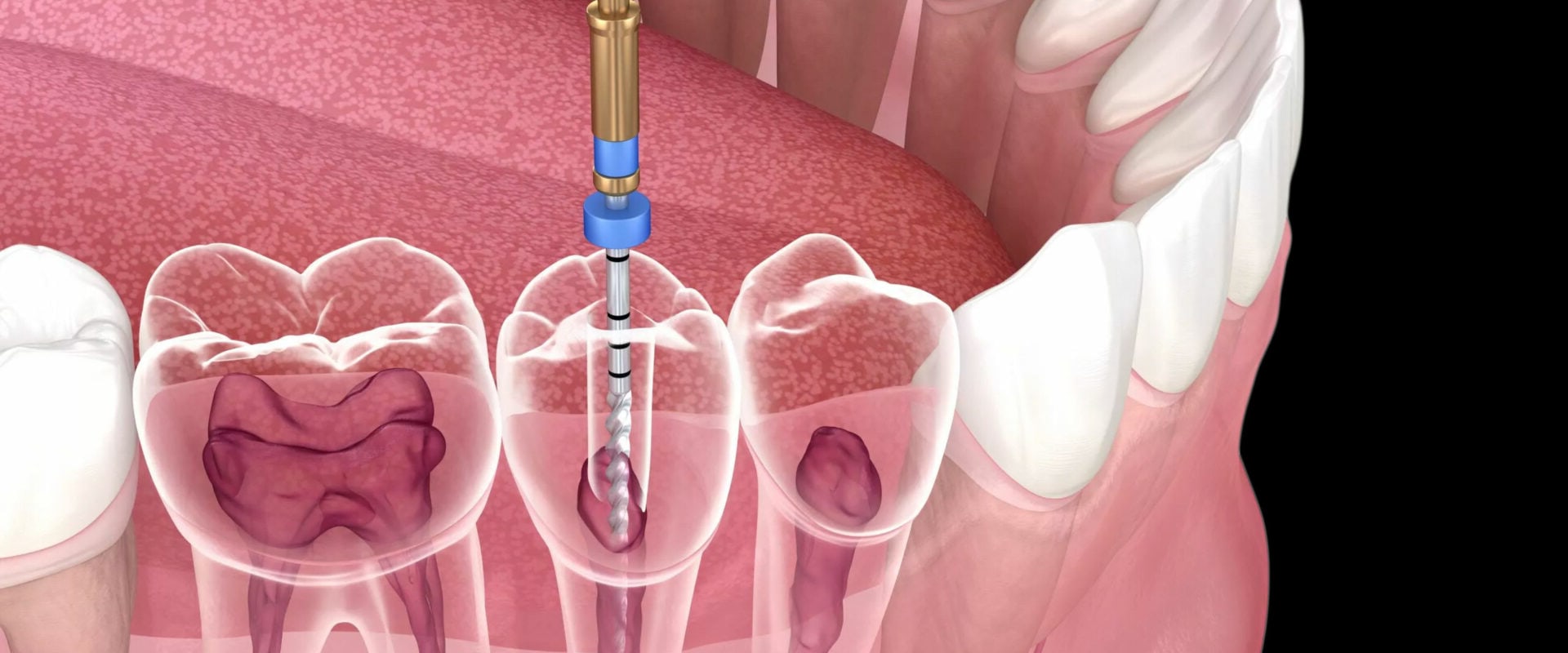 Understanding the Root Canal Procedure: What You Need to Know