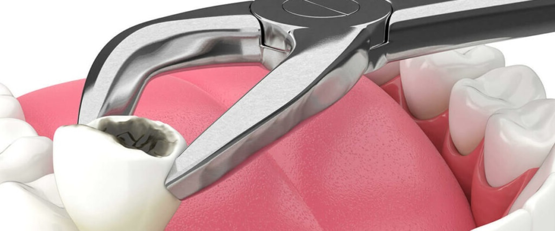 The Extraction Process: A Guide to Understanding Tooth Extractions